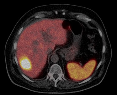 Ga-68 tracers - Aarhus Universitetshospital